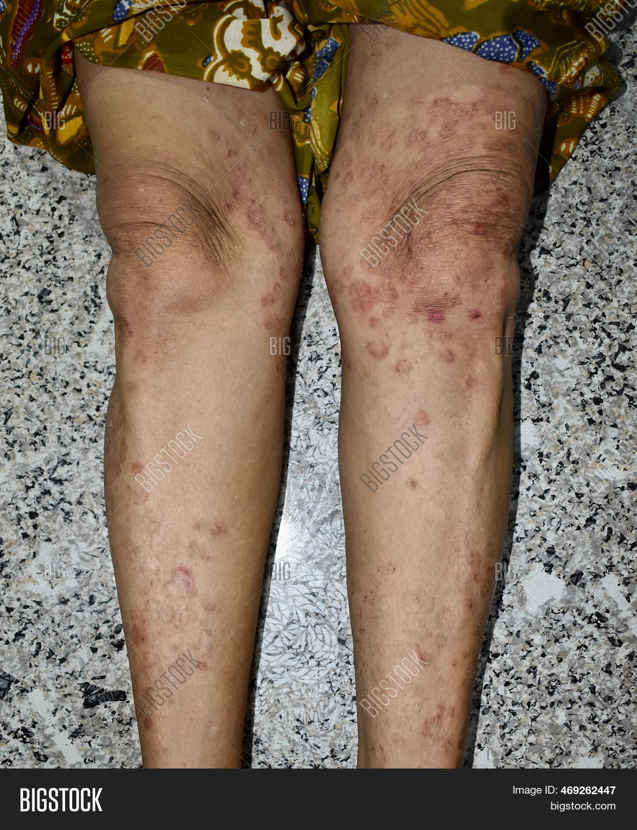 Fungal Infection Image & Photo (Free Trial) | Bigstock