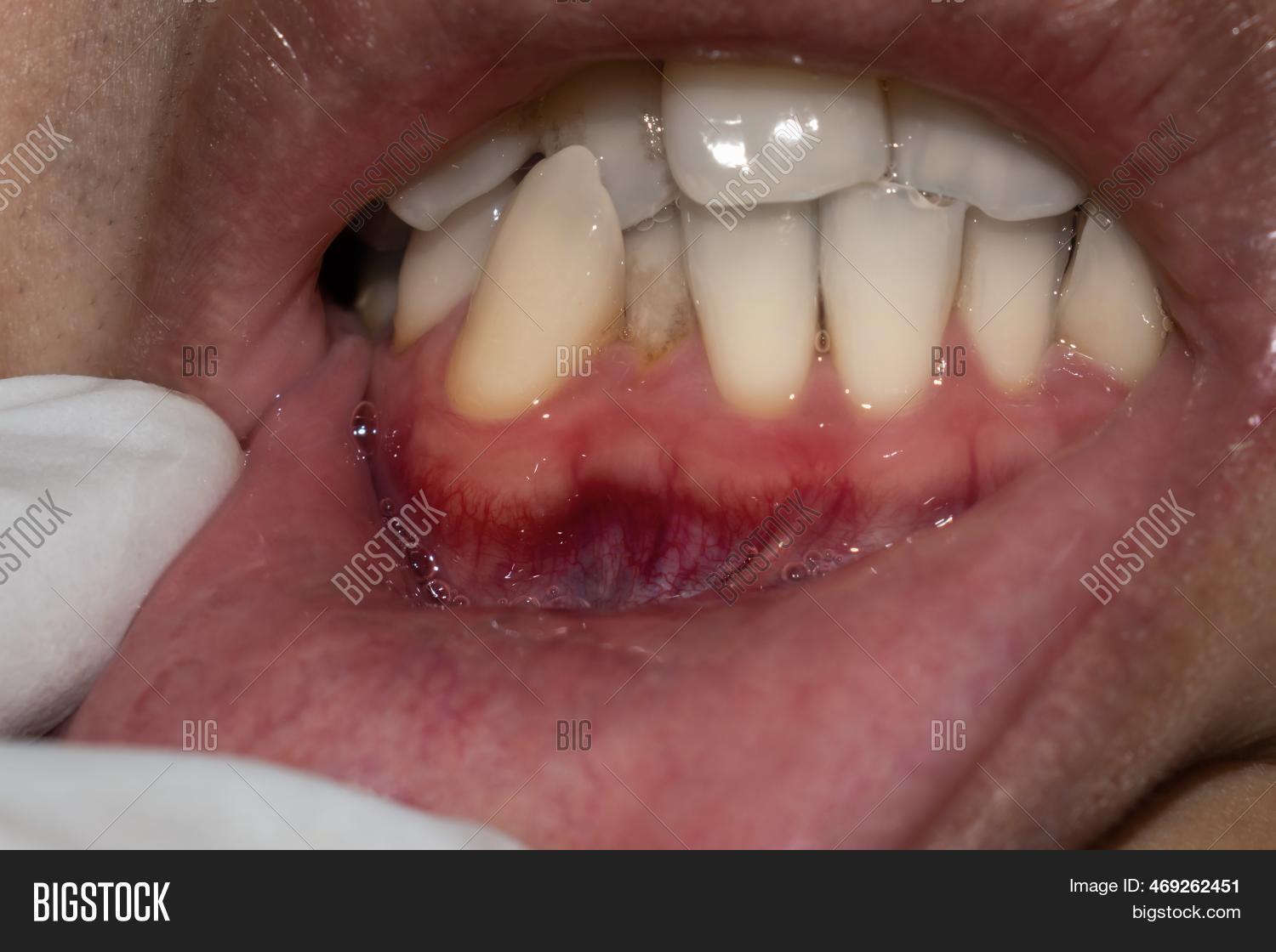 Inflammation Gum Image & Photo (Free Trial) | Bigstock