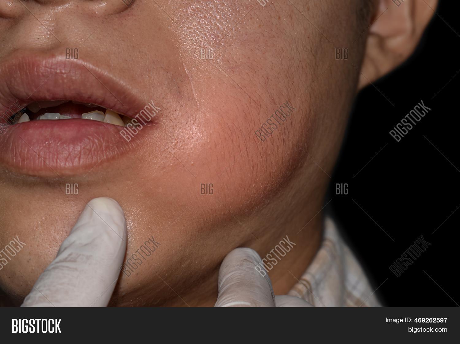 Swelling Cheek Asian Image & Photo (Free Trial) | Bigstock