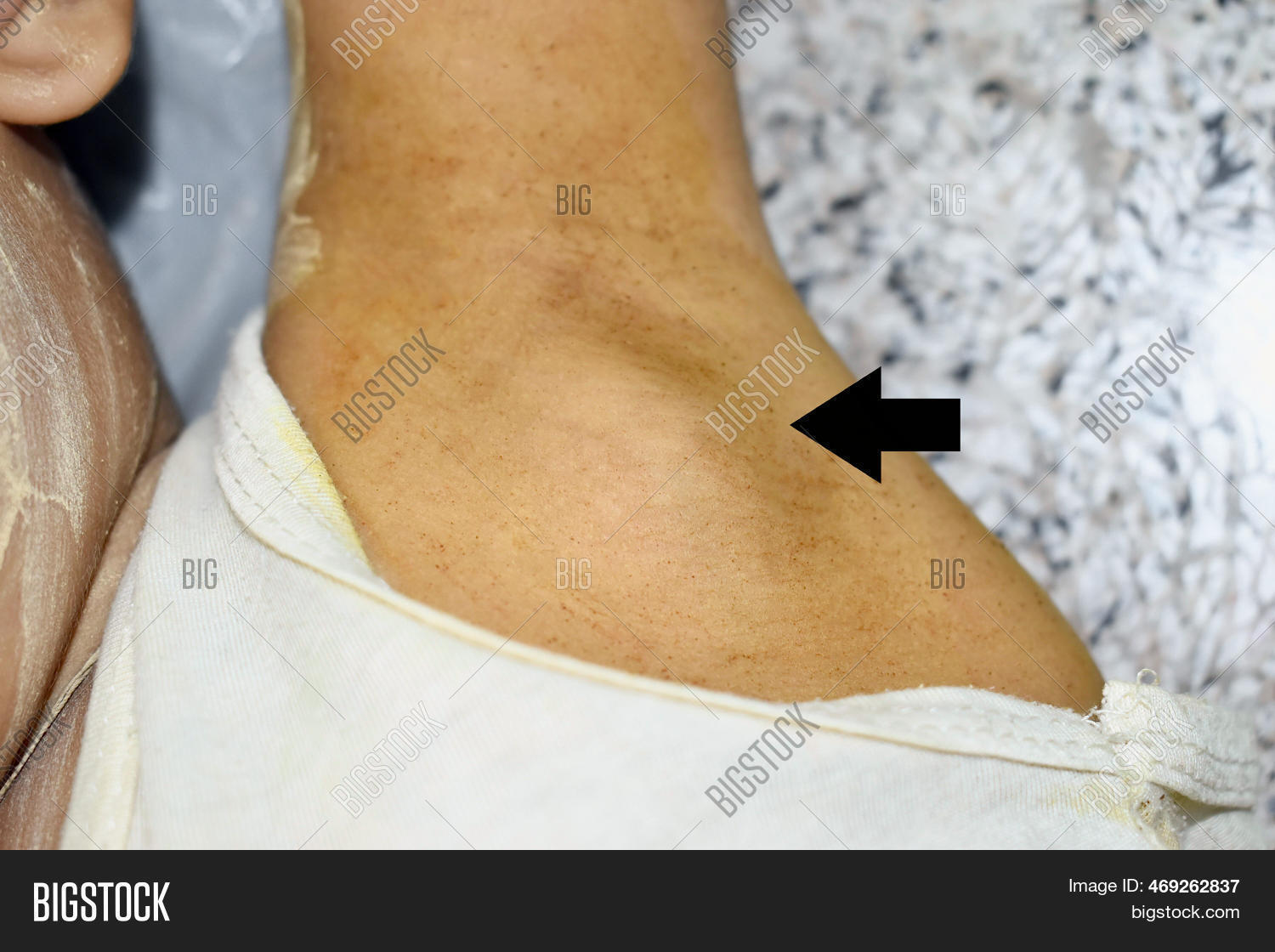 Painful Large Swelling Image & Photo (Free Trial) | Bigstock