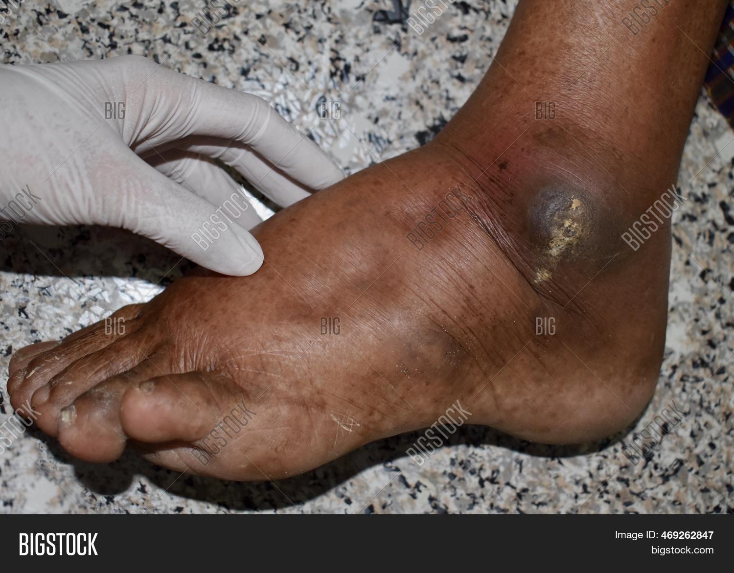 Pitting Edema Lower Image & Photo (Free Trial) | Bigstock