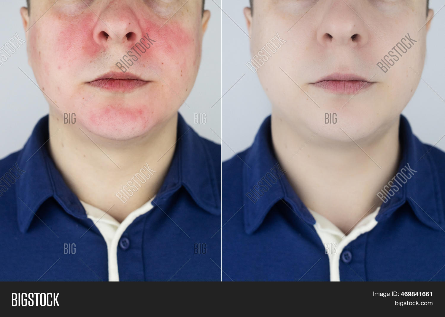 Rosacea Face. Man Image & Photo (Free Trial) | Bigstock