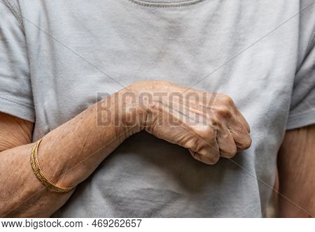 Volkmann Contracture Image & Photo (Free Trial) | Bigstock