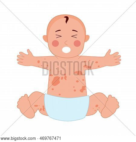 Baby Diaper Rash On Vector & Photo (Free Trial) | Bigstock
