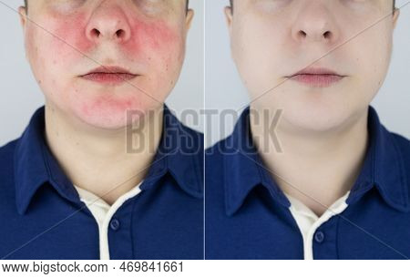 Rosacea Face. Man Image & Photo (Free Trial) | Bigstock