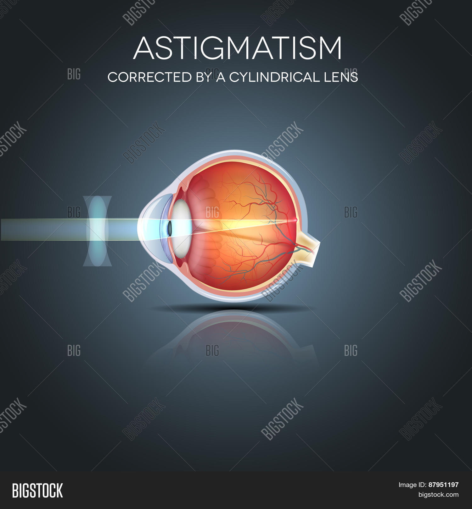 Astigmatism Corrected Vector & Photo (Free Trial) | Bigstock