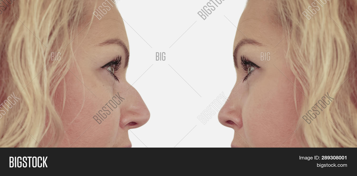 Female Nose Hump Image & Photo (Free Trial) | Bigstock