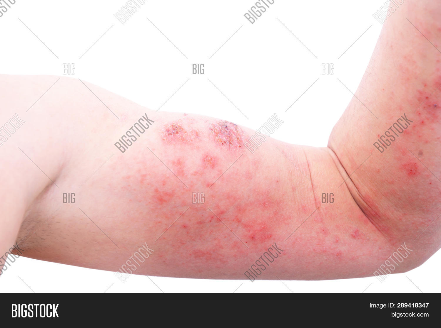 Atopic Dermatitis (ad Image & Photo (Free Trial) | Bigstock