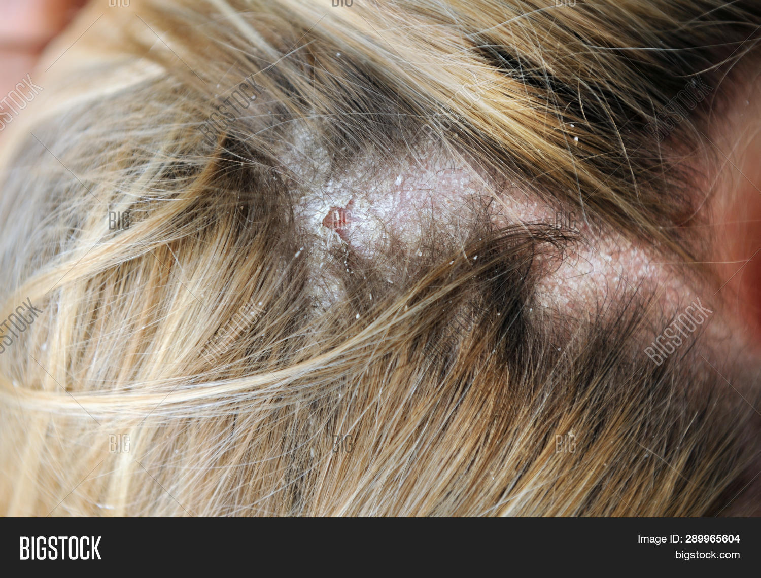 Dandruff Seborrhea Image & Photo (Free Trial) | Bigstock