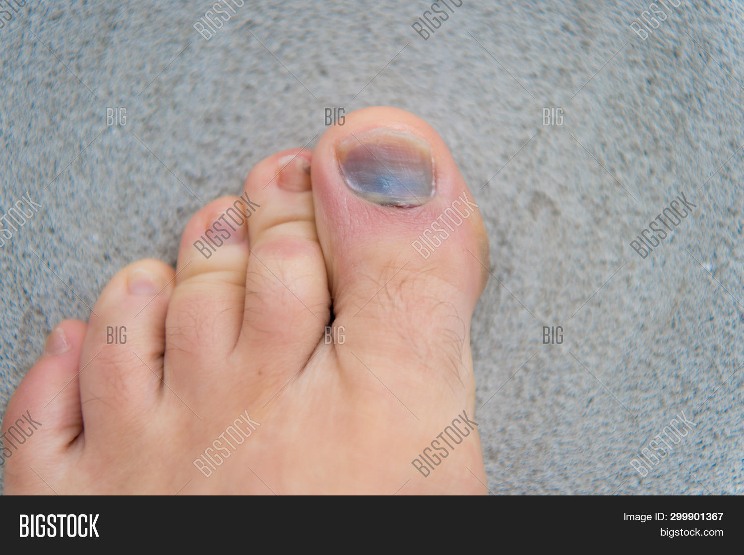 Finger Disease. Image & Photo (Free Trial) | Bigstock