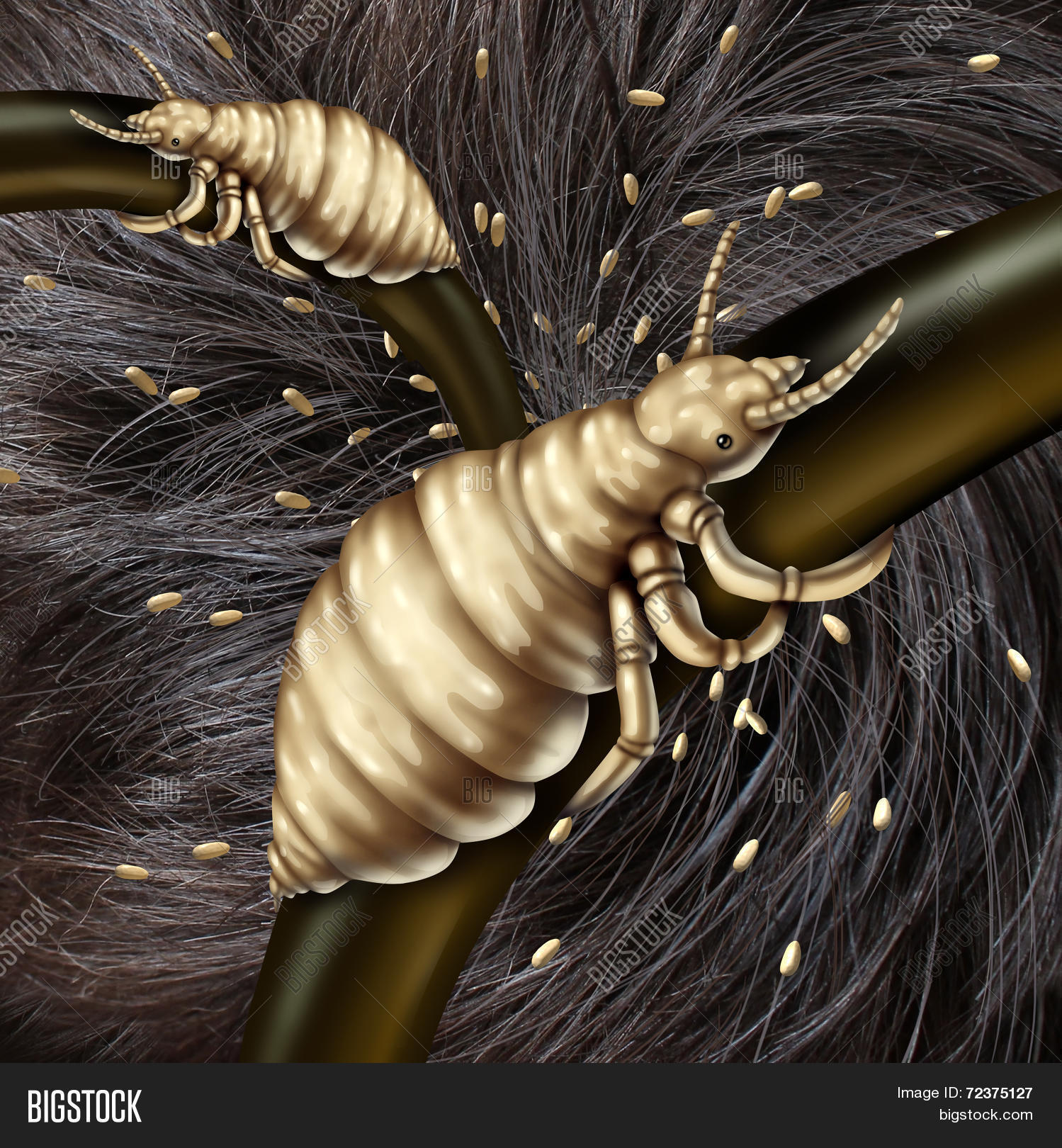 Lice In Hair Stock Photo & Stock Images | Bigstock