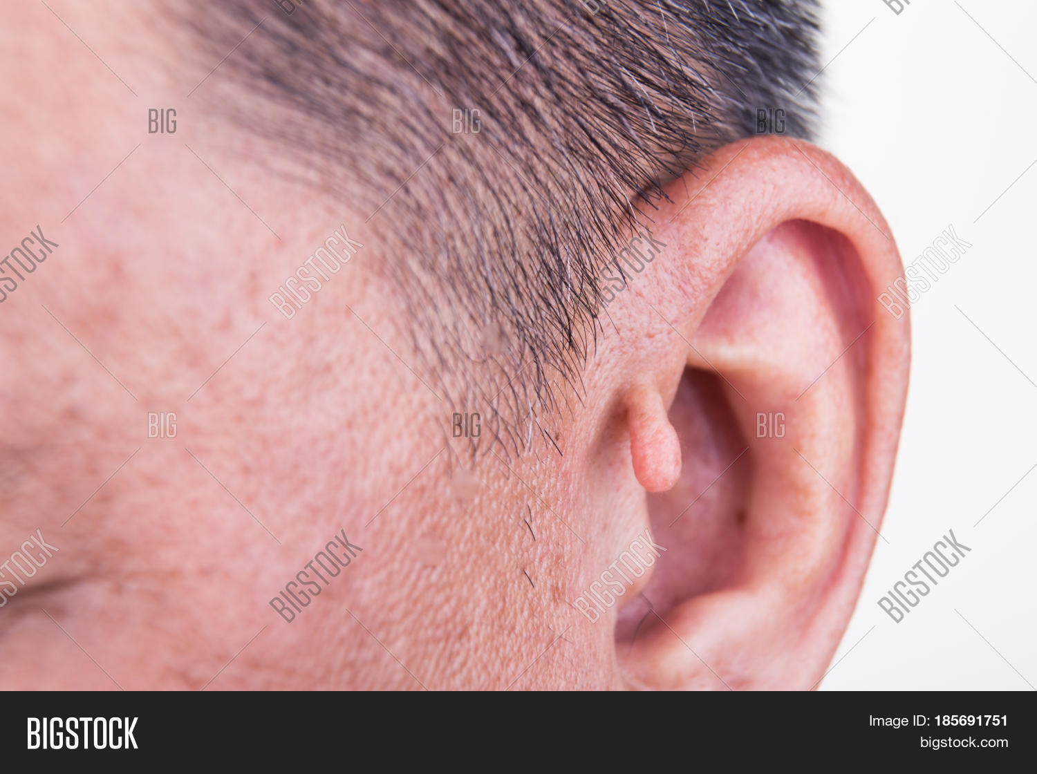 Human Mutation Extra Growth On Ear Image & Photo | Bigstock