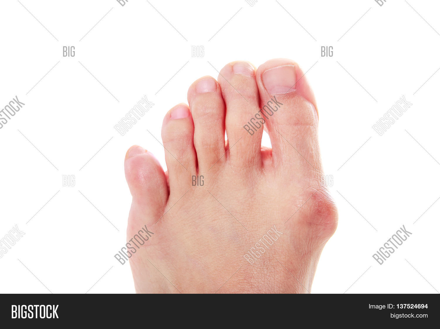Dislocated Little Toe, Big Toe Image & Photo | Bigstock