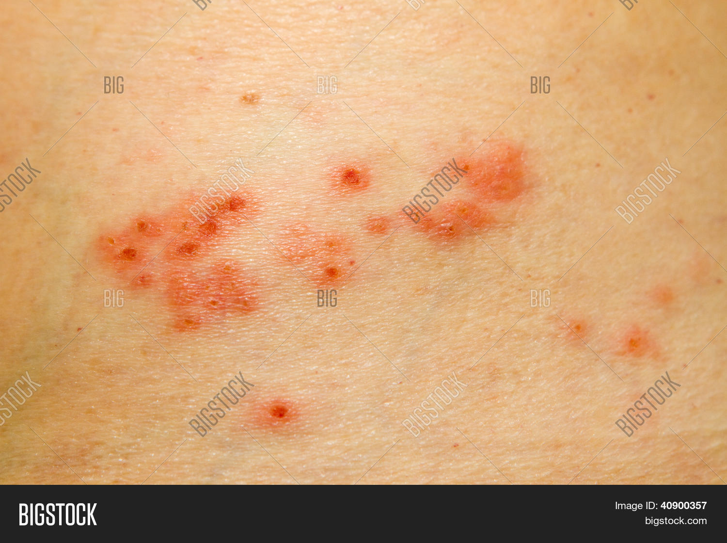 Shingles Rash Image & Photo | Bigstock